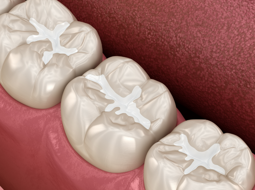 5 Reasons Why Tooth-Colored Fillings Beat Amalgam Fillings